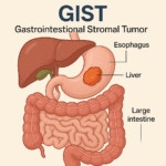 Understanding GIST: Gastrointestinal Stromal Tumour Explained | The ...